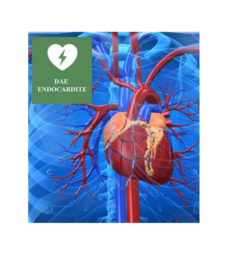 L'ENDOCARDITE - Defibrillatori Shop di Dartizio Michele